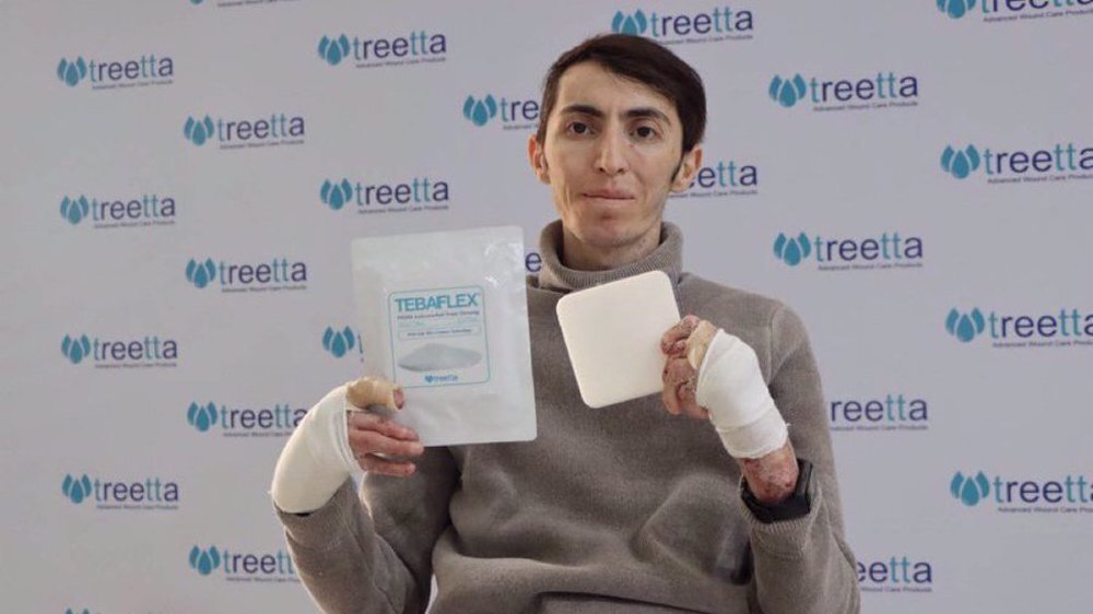 Iranian firm produces wound dressings for rare skin disease - Mehr News ...